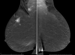 mammogram screening abnormality