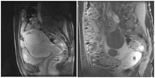 Uterine Fibroids & Uterine Artery Embolization