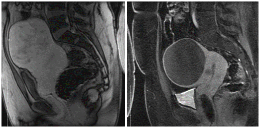 Uterine Fibroids & Uterine Artery Embolization